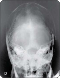 Método De Towne Ou Incidência AP Axial Anteroposterior Do Crânio ...