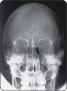Raios X Seios Da Face - Método De Caldwell - Radiologia Ja