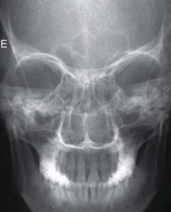 Método De CALDWELL - Incidência Posteroanterior Axial - Concursos Já Brasil